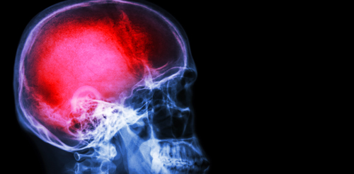 Traumatic Brain Injury (TBI): What is the Glasgow Coma Scale? - Tehrani ...